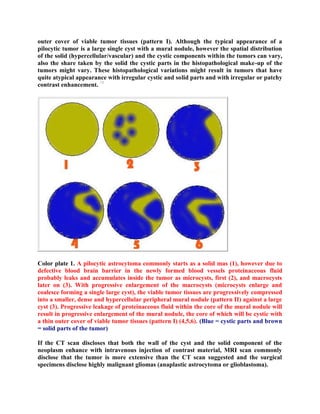 Topic of the month: Radiological pathology of pilocytic astrocytoma | PDF