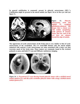 Topic of the month: Radiological pathology of pilocytic astrocytoma | PDF