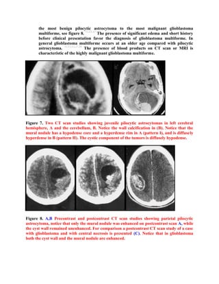 Topic of the month: Radiological pathology of pilocytic astrocytoma | PDF