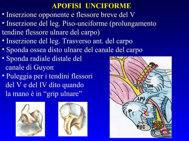 Pseudoartrosi congenita dell'apofisi unciforme dell'osso uncinato | PPT