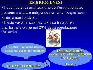 Pseudoartrosi congenita dell'apofisi unciforme dell'osso uncinato | PPT