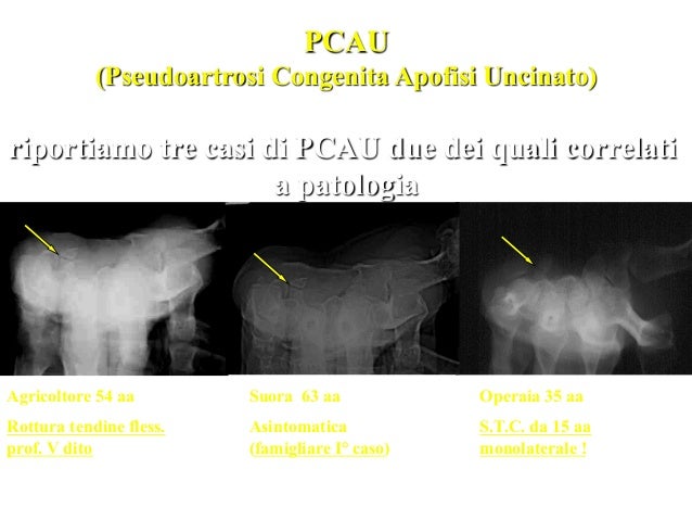 Pseudoartrosi congenita dell'apofisi unciforme dell'osso uncinato