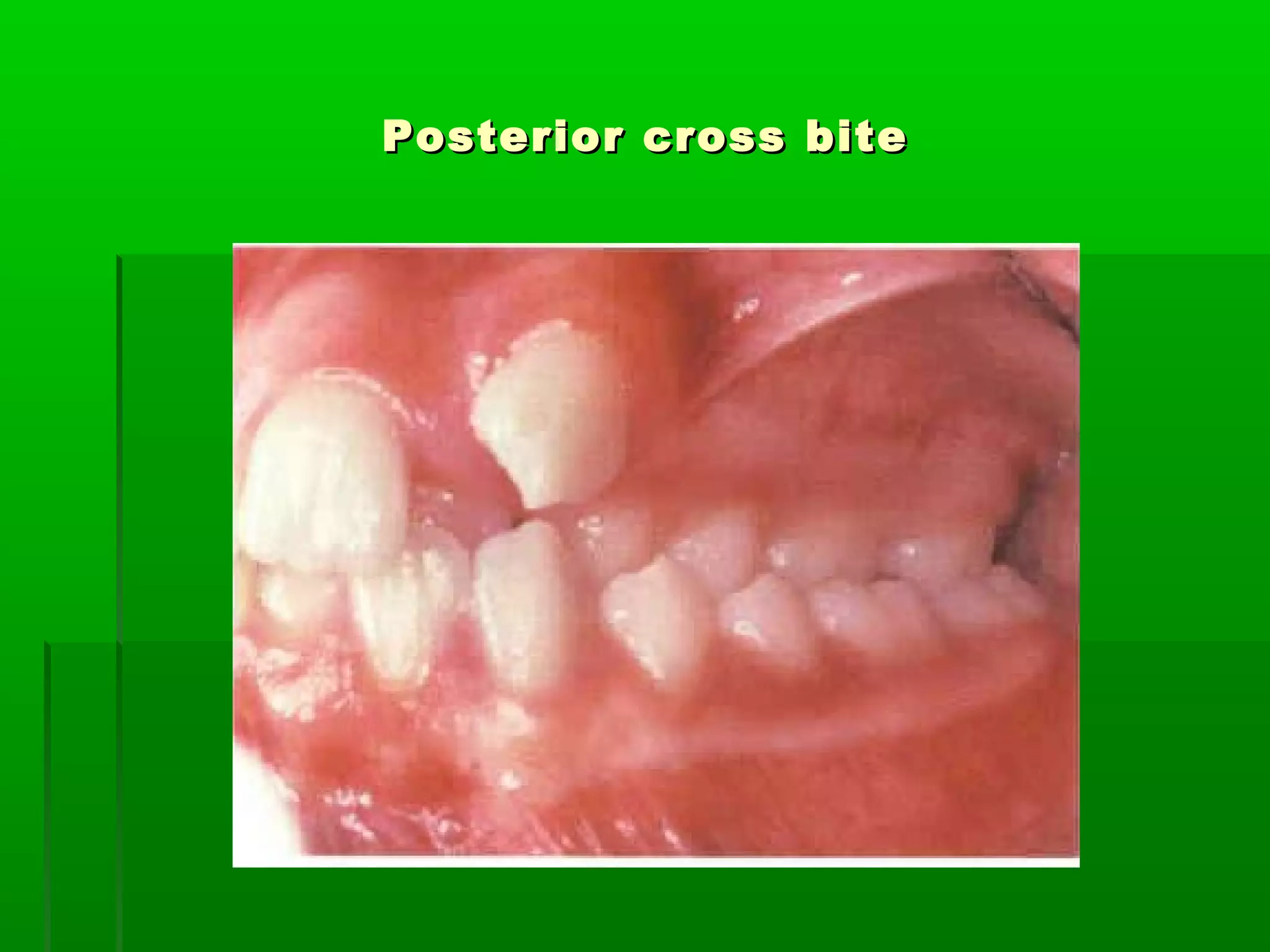 Posterior Crossbite | PPT