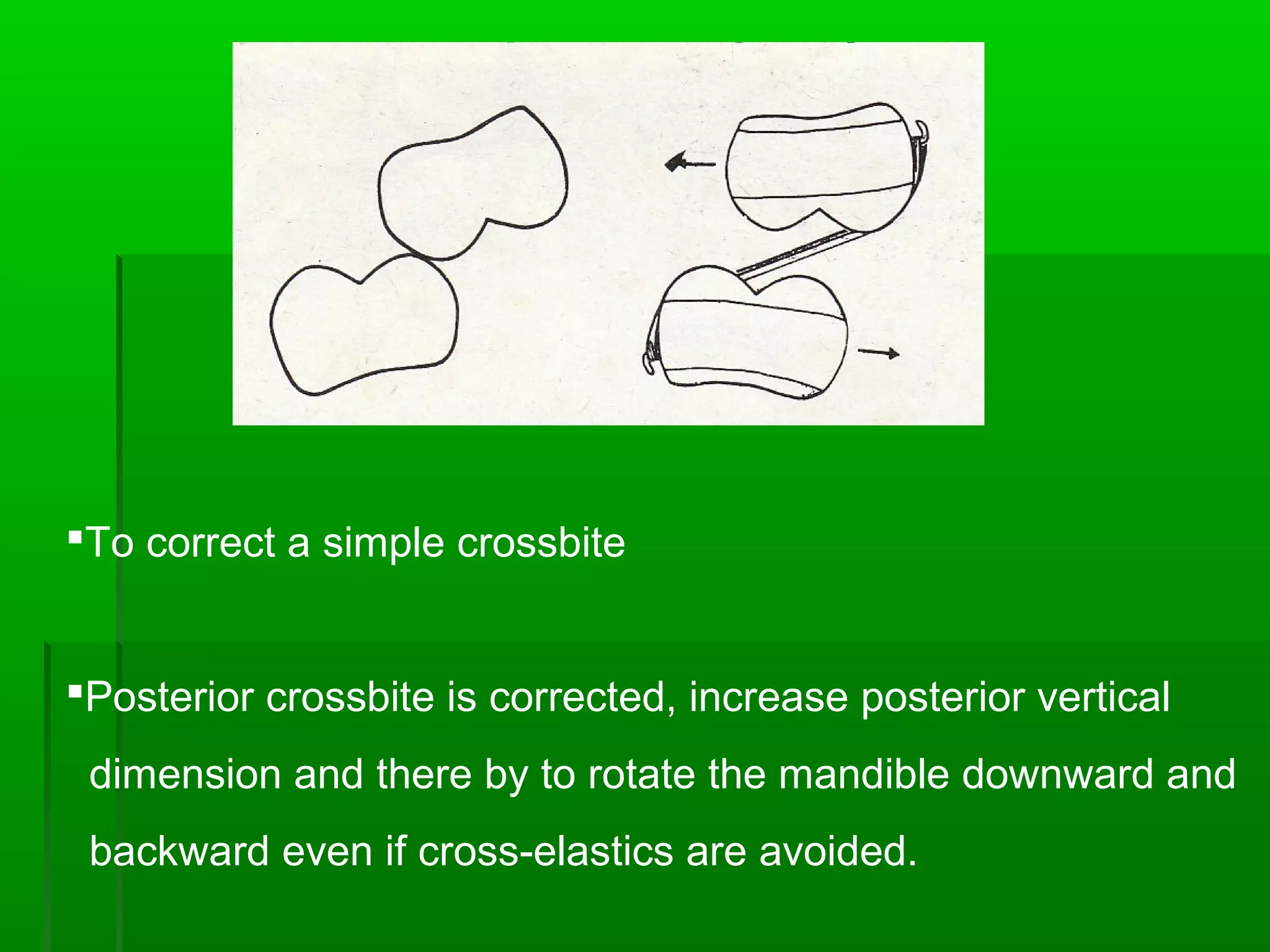 Posterior Crossbite | PPT
