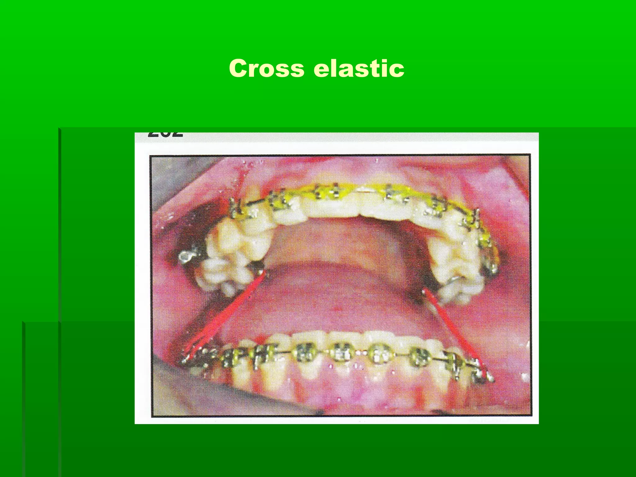 Posterior Crossbite | PPT