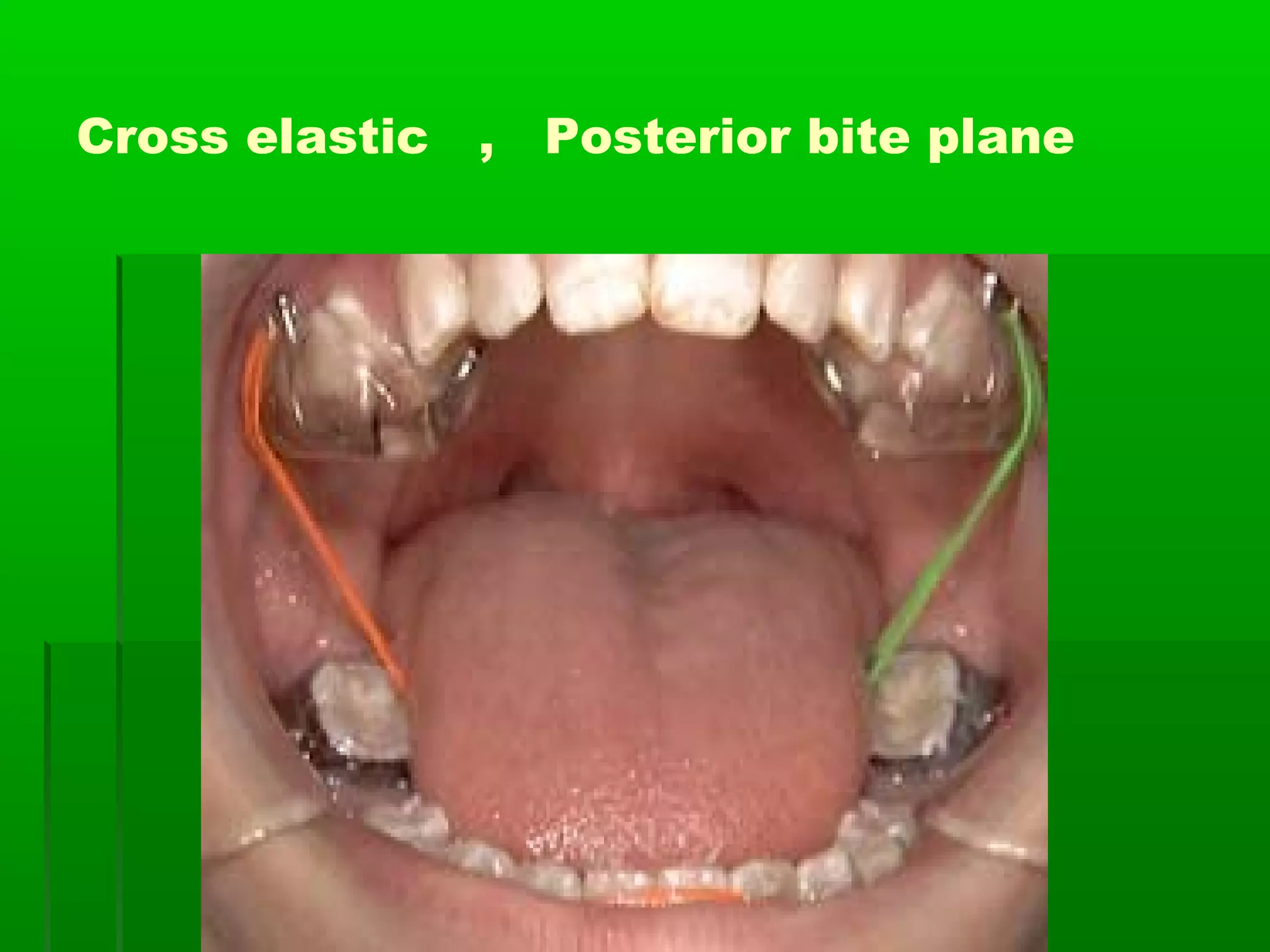 Posterior Crossbite | PPT