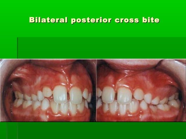 Posterior Crossbite | PPT