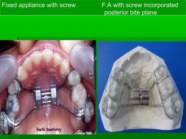 Posterior Crossbite | PPT