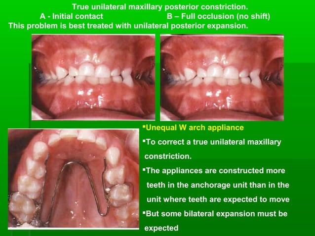 Posterior Crossbite | PPT