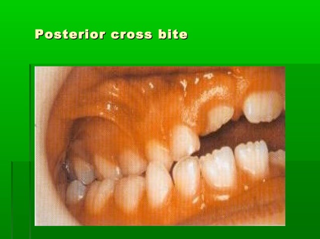 Posterior Crossbite | PPT