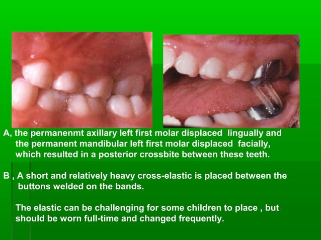Posterior Crossbite | PPT
