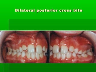 Unilateral Posterior Crossbite