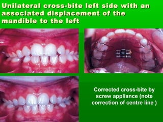 Unilateral Posterior Crossbite