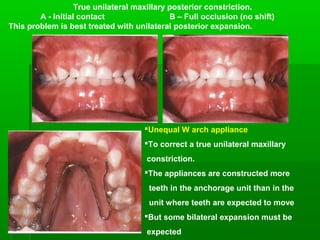 Posterior Crossbite