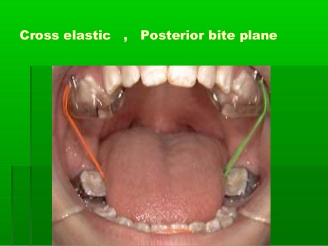 Posterior Crossbite