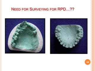 Surveying and Designing in Cast Partial Denture | PPT