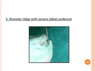 Surveying and Designing in Cast Partial Denture | PPT