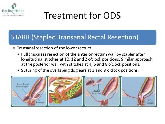 STARR Surgery for ODS | Defecography in Pune | Healing Hands Clinic P…
