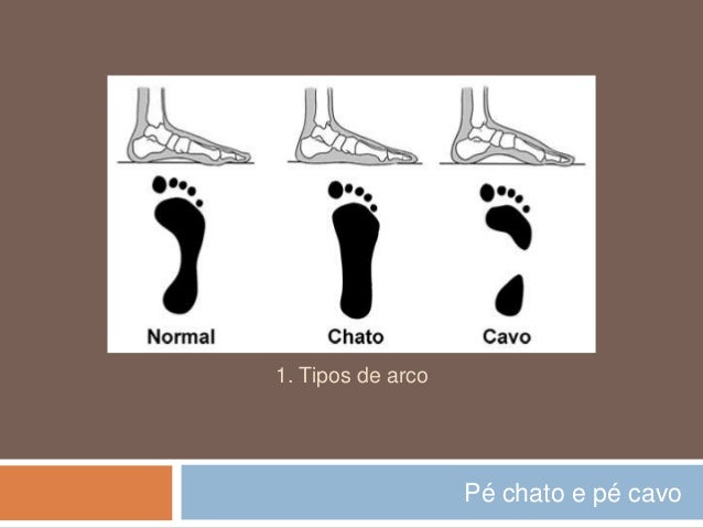 Pé chato e pé cavo