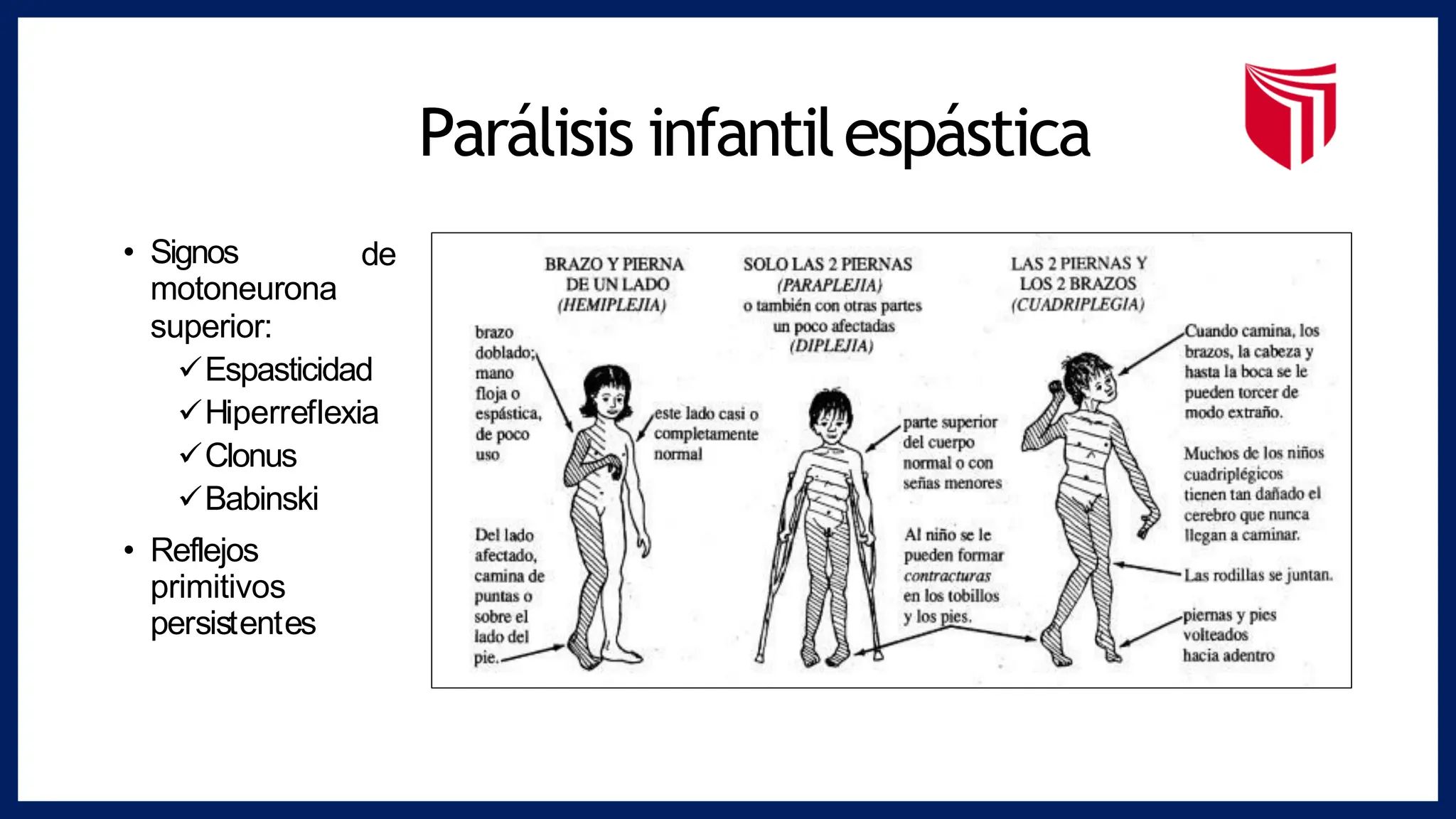 Paralisis cerebral infantil - Rehabilitación física | PPT