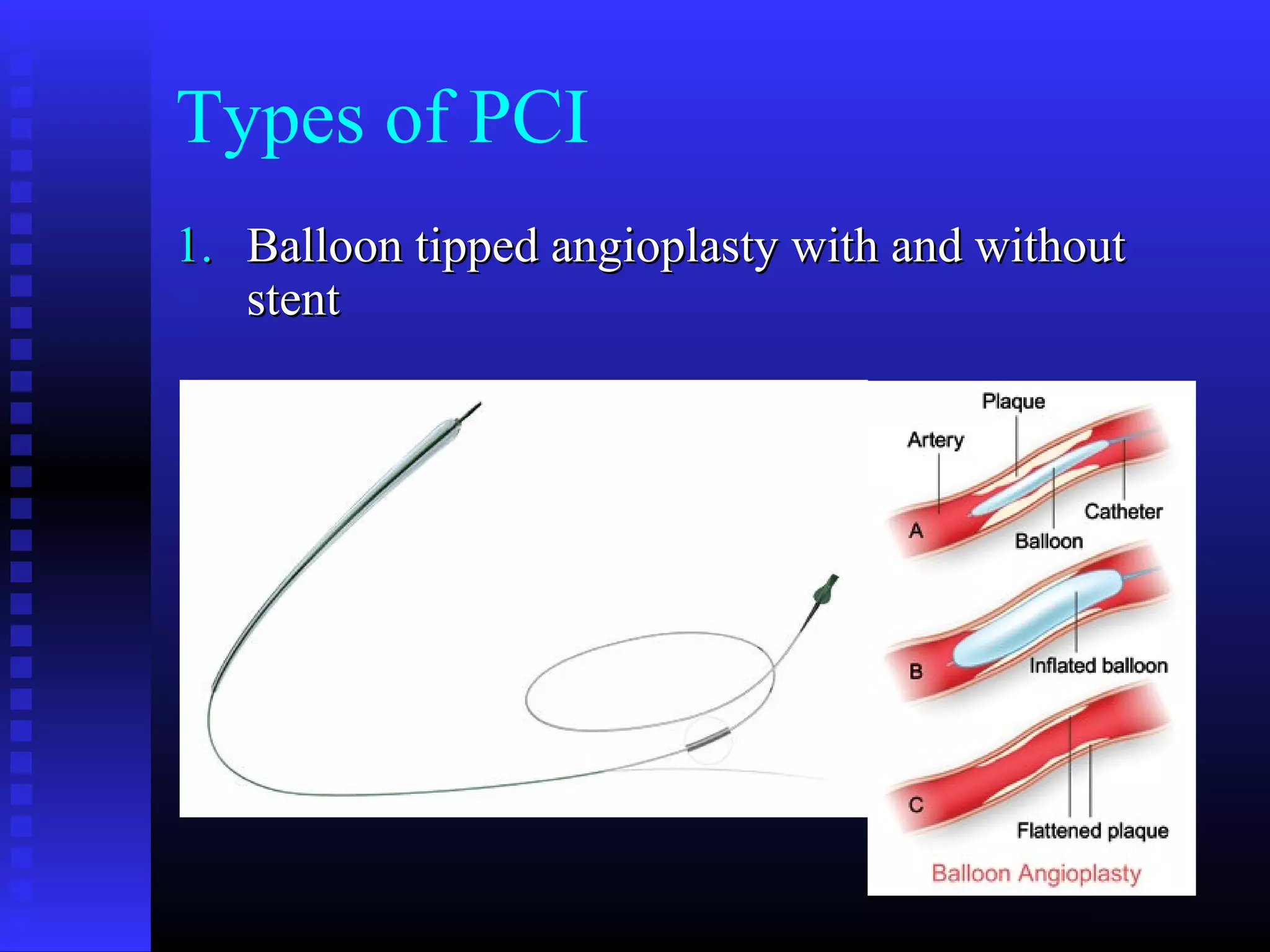 Percutaneous Coronary Intervention (PCI),(Kurdistan) | PPT