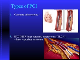 Percutaneous Coronary Intervention (PCI),(Kurdistan) | PPT