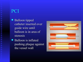 Percutaneous Coronary Intervention (PCI),(Kurdistan) | PPT
