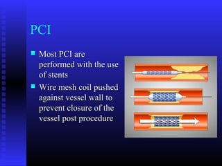 Percutaneous Coronary Intervention (PCI),(Kurdistan) | PPT