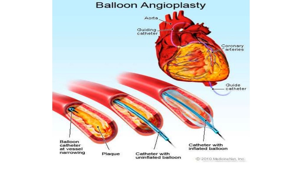 Percutaneous Coronary Intervention