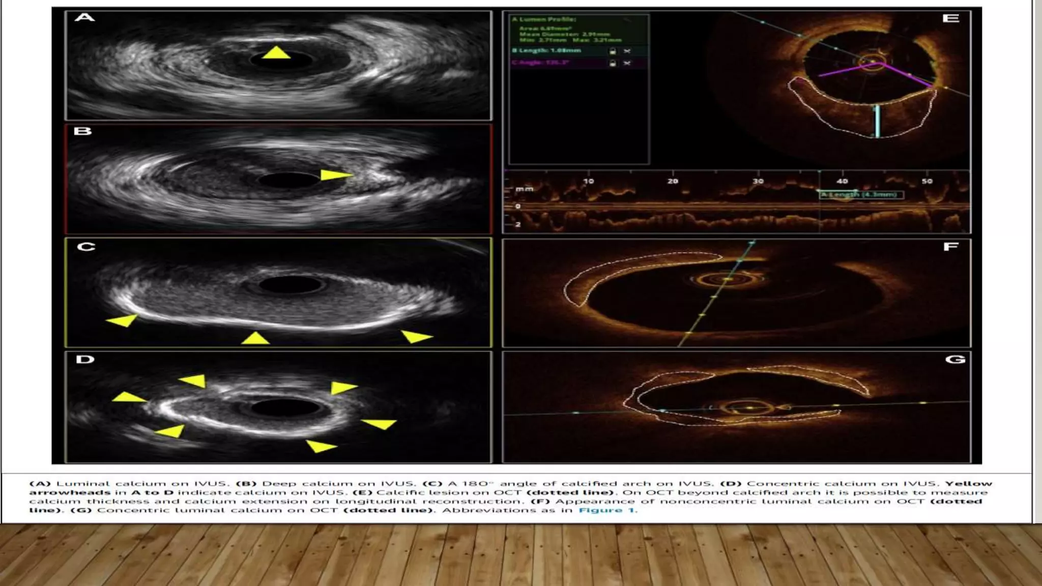 PCI in calcified lesions.pptx