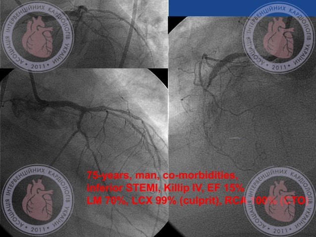 Pci in stemi. state of the art. Petr widimsky | PPT