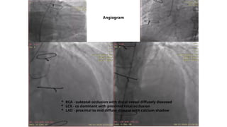 Percutaneous coronary intervention of diffuse disease in Coronary ...