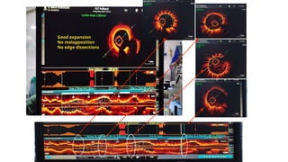 Percutaneous coronary intervention of diffuse disease in Coronary ...