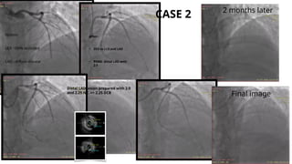Percutaneous coronary intervention of diffuse disease in Coronary ...