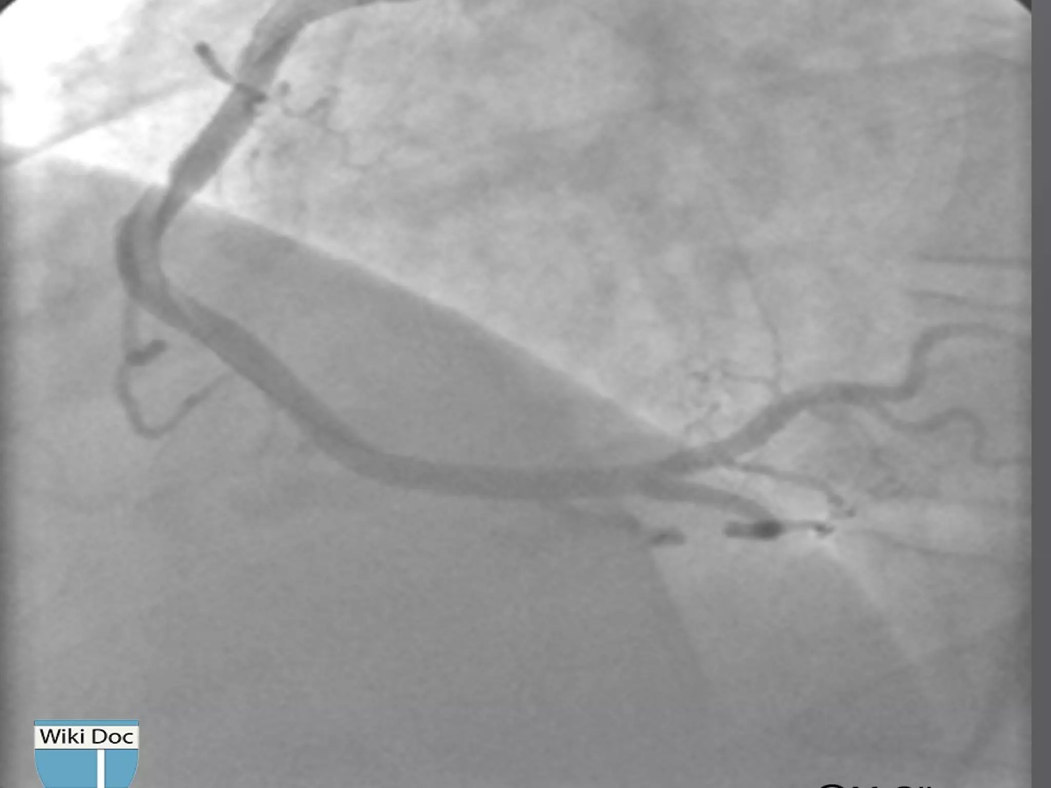 PCI procedure complication | ODP