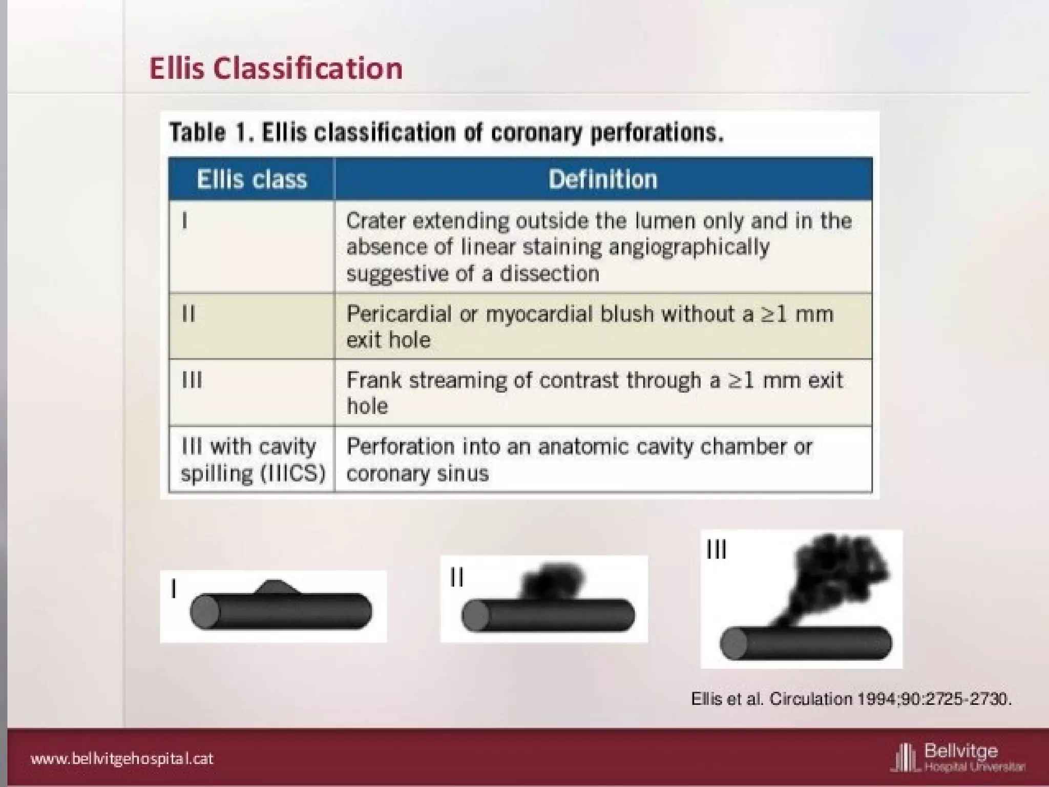 PCI procedure complication | ODP