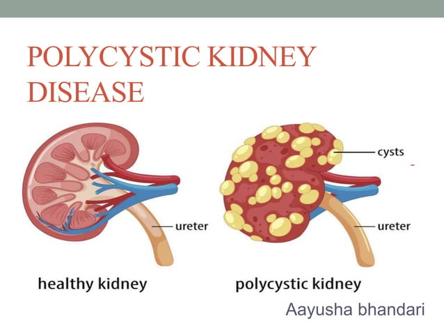 Polycystic kidney disease | PPT