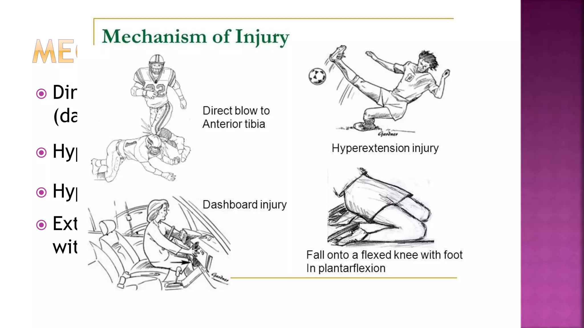 Posterior Cruciate Ligament Injury | PPT