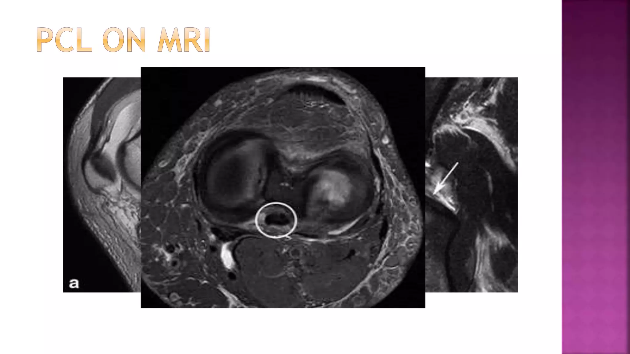 Posterior Cruciate Ligament Injury | PPT