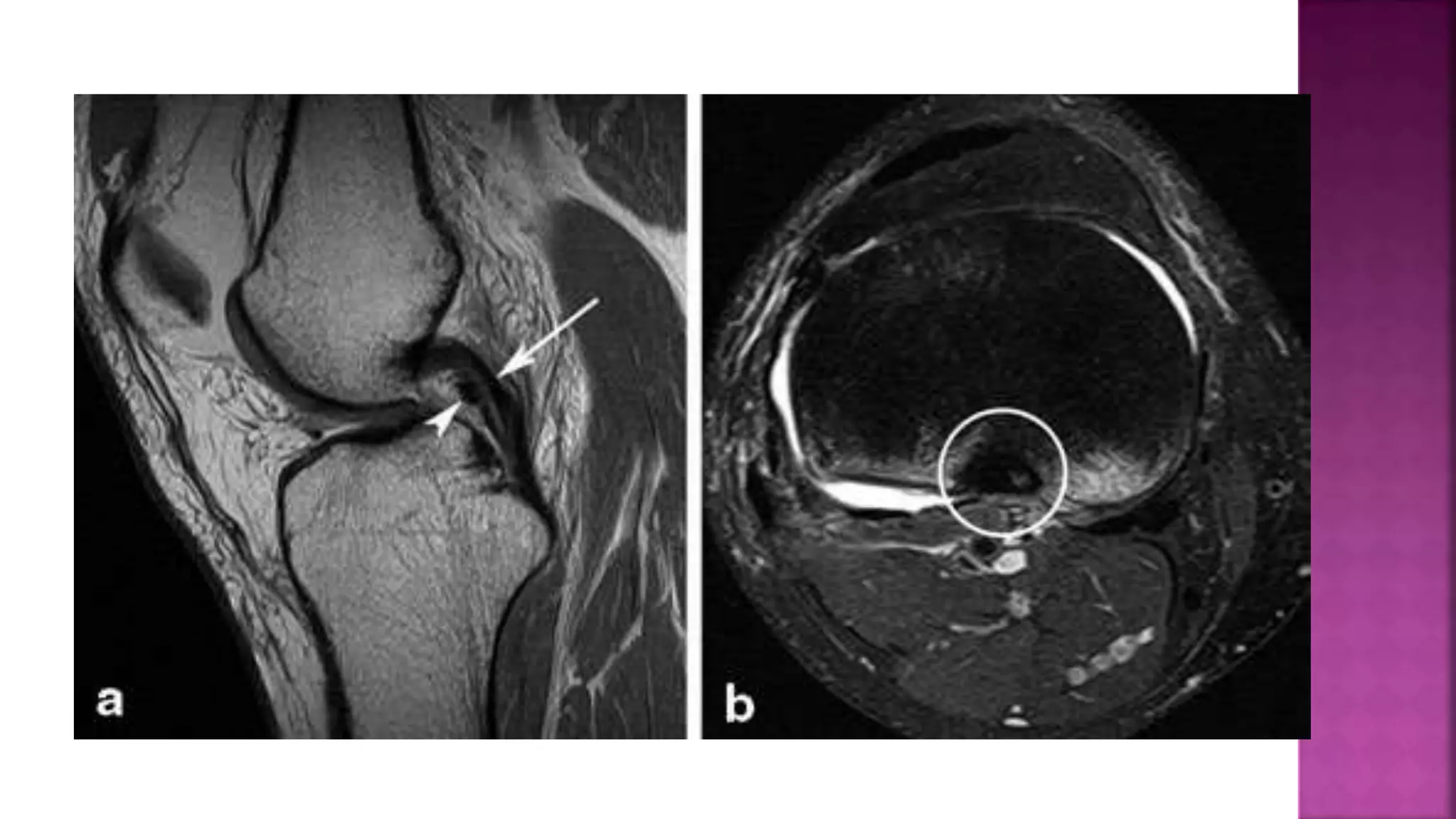 Posterior Cruciate Ligament Injury | PPT