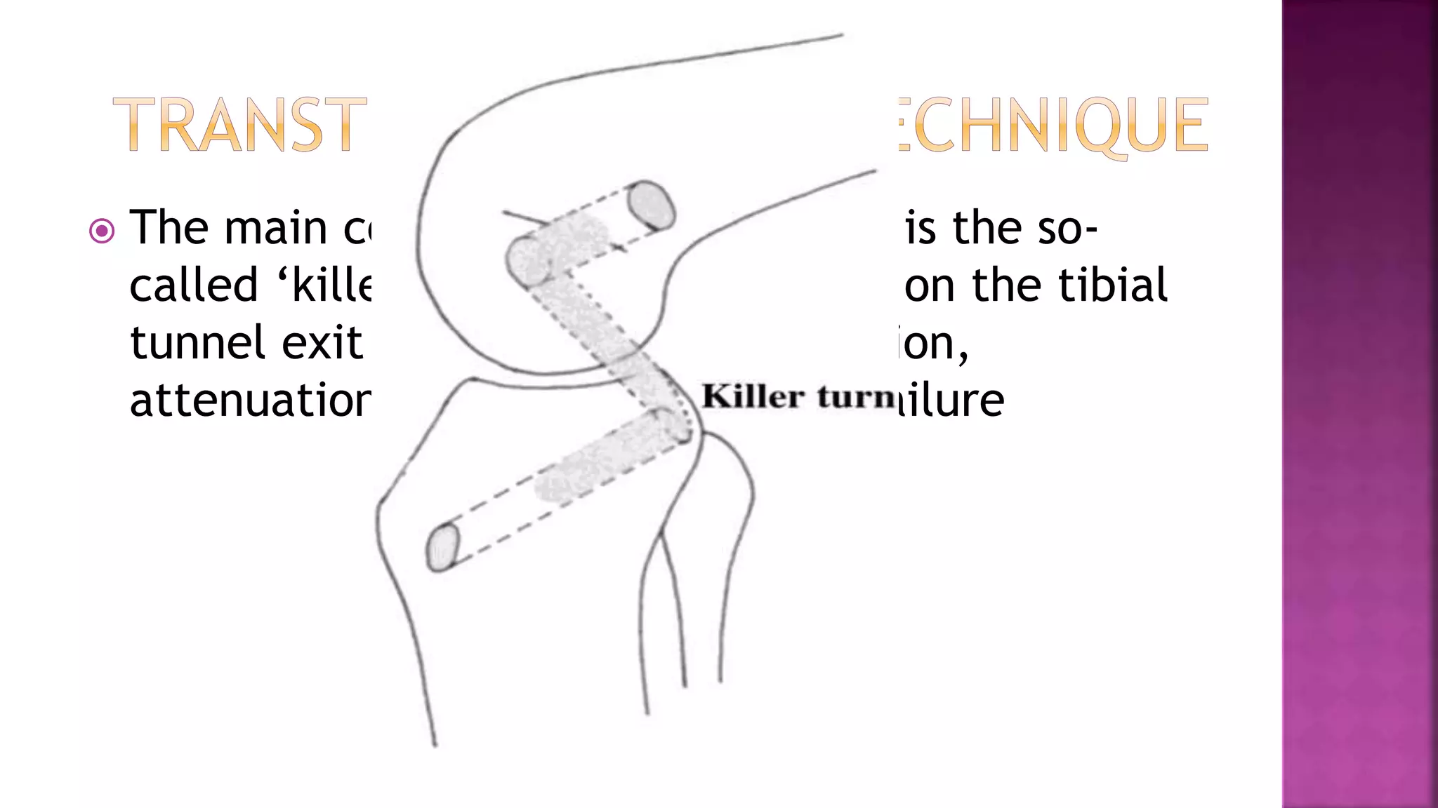 Posterior Cruciate Ligament Injury | PPT