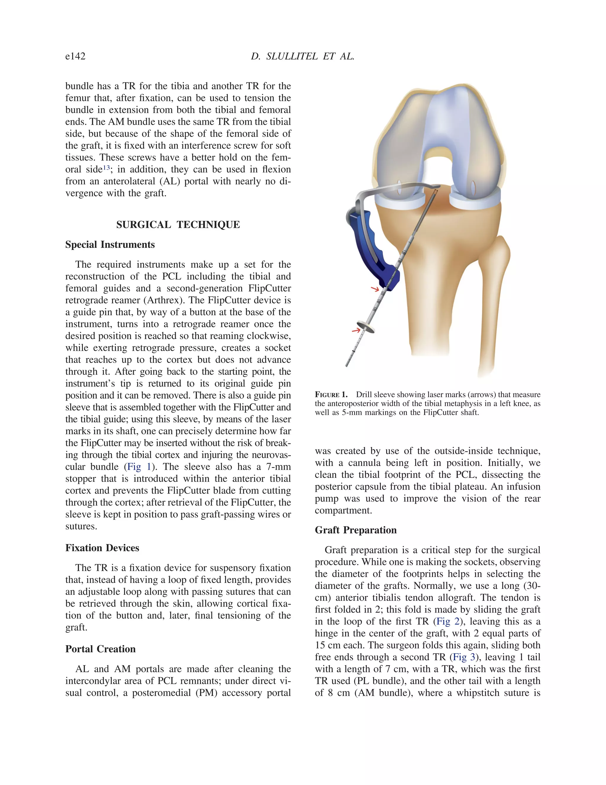 DOUBLE-BUNDLE "ALL-INSIDE" POSTERIOR CRUCIATE LIGAMENT RECONSTRUCTION | PDF