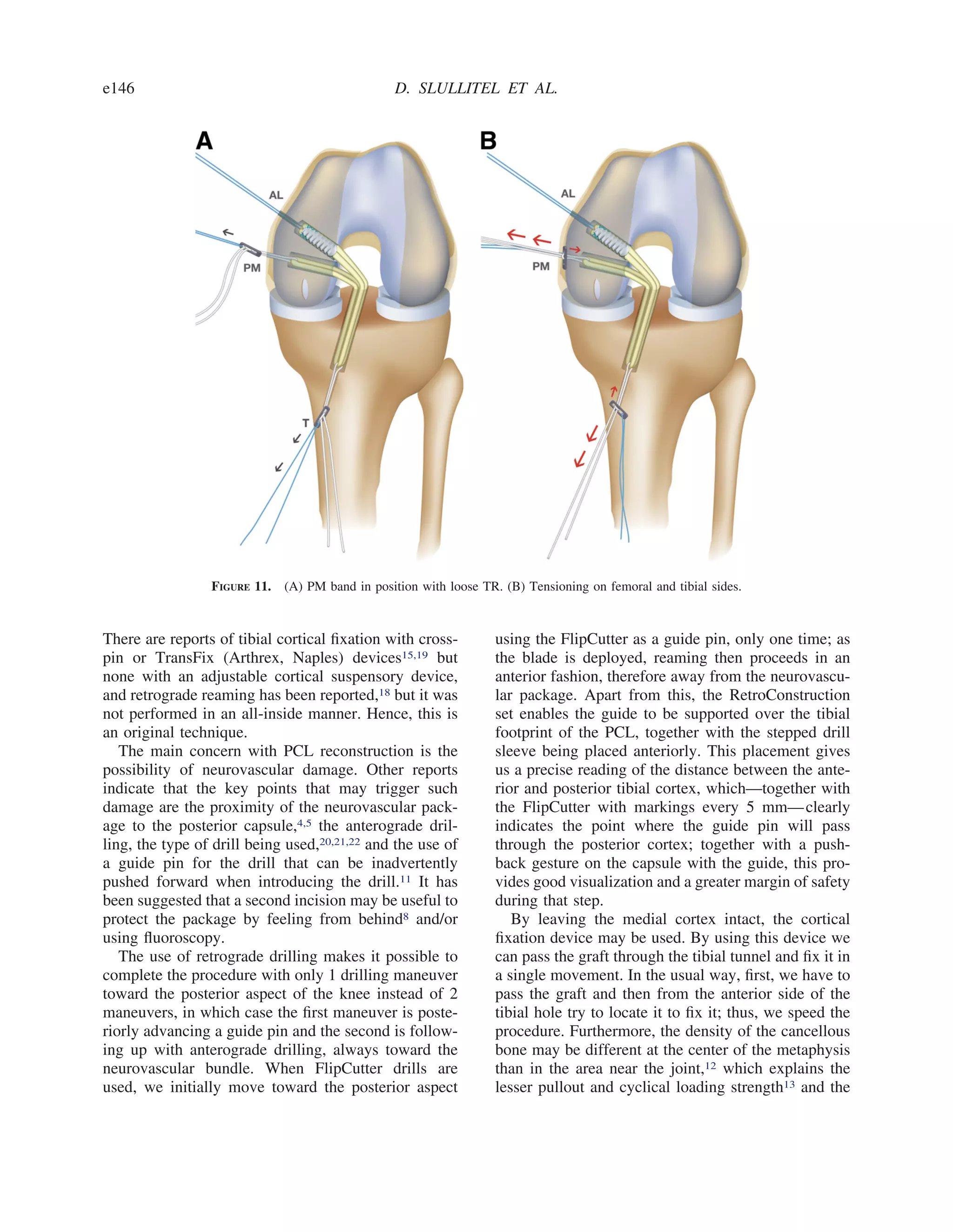 DOUBLE-BUNDLE "ALL-INSIDE" POSTERIOR CRUCIATE LIGAMENT RECONSTRUCTION | PDF