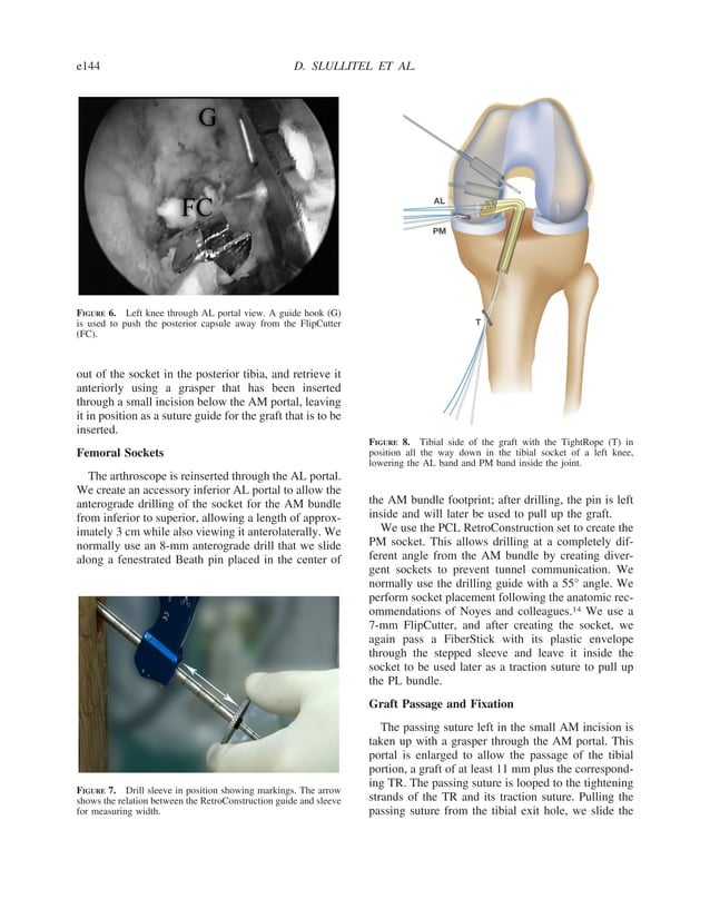 DOUBLE-BUNDLE "ALL-INSIDE" POSTERIOR CRUCIATE LIGAMENT RECONSTRUCTION | PDF