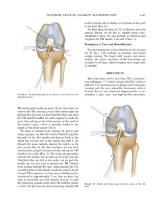DOUBLE-BUNDLE "ALL-INSIDE" POSTERIOR CRUCIATE LIGAMENT RECONSTRUCTION | PDF