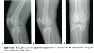Pcl avulsion | PPTX