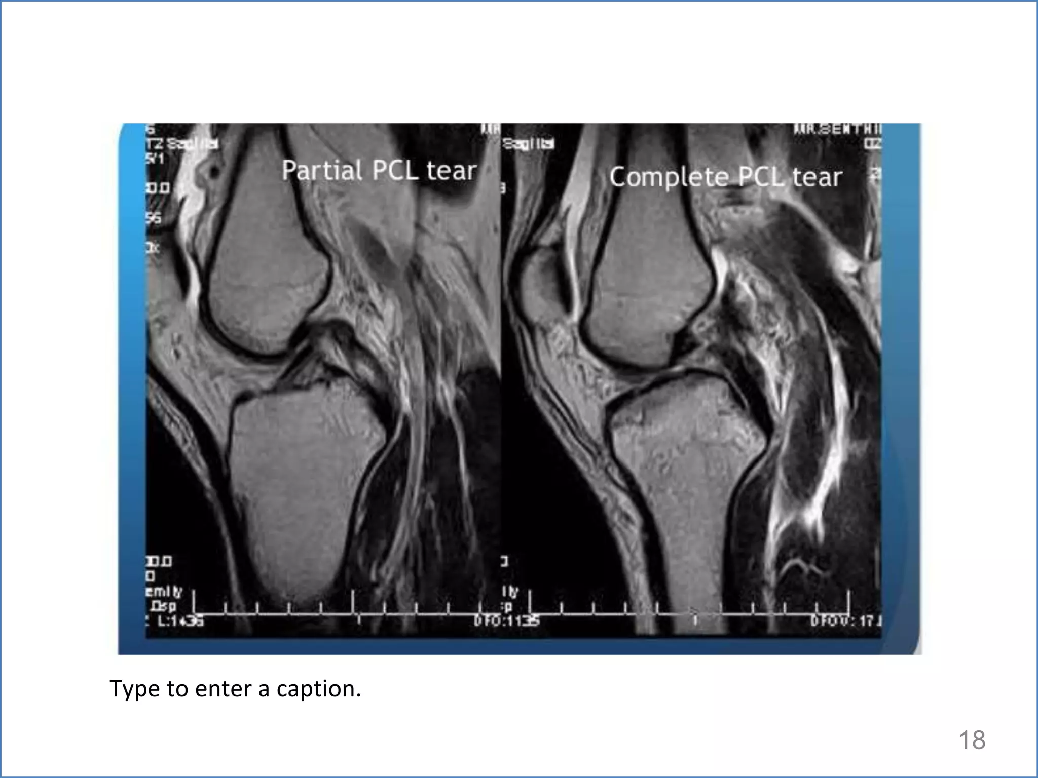 PCL POSTERIOR CRUCIATE LIGAMENT OF KNEE JOINT SPORTS INJURY: HOW TO ...