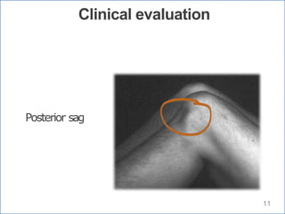 PCL POSTERIOR CRUCIATE LIGAMENT OF KNEE JOINT SPORTS INJURY: HOW TO ...