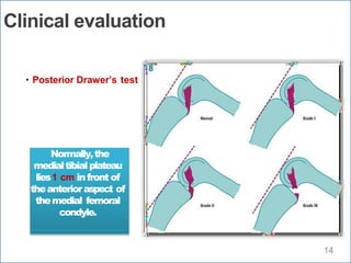 PCL POSTERIOR CRUCIATE LIGAMENT OF KNEE JOINT SPORTS INJURY: HOW TO ...