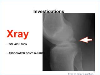 PCL POSTERIOR CRUCIATE LIGAMENT OF KNEE JOINT SPORTS INJURY: HOW TO ...